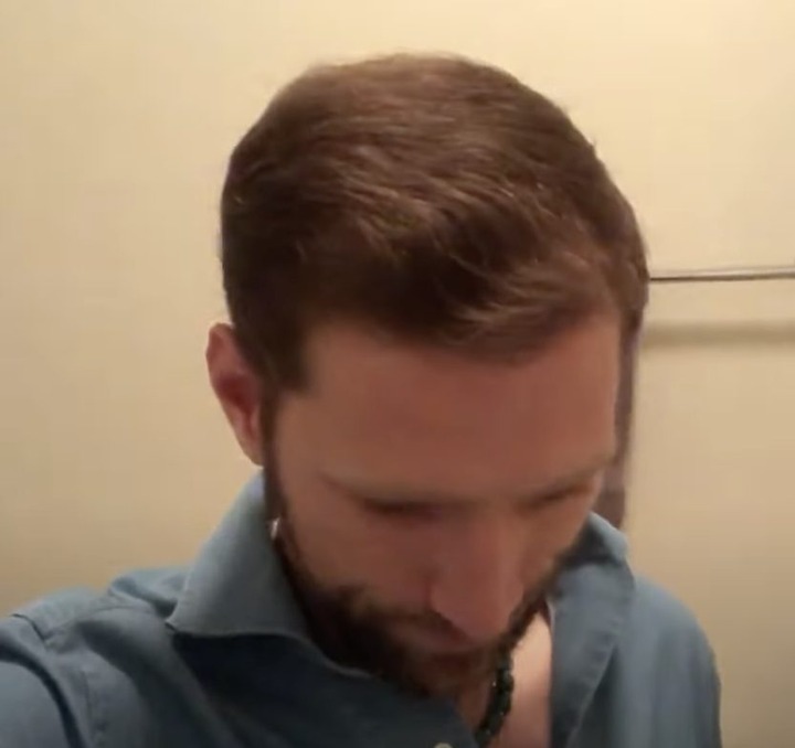 Finasteride Results: Timeline, Photos, Before & After