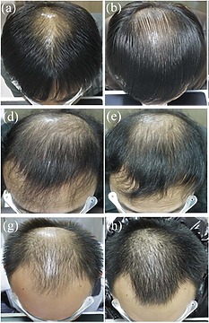 Finasteride Results: Timeline, Photos, Before & After