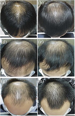 Finasteride Results: Timeline, Photos, Before & After