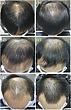 Finasteride Results: Timeline, Photos, Before & After