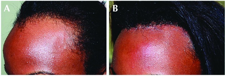 Forehead Reduction Surgery: Procedure, Costs, Alternatives