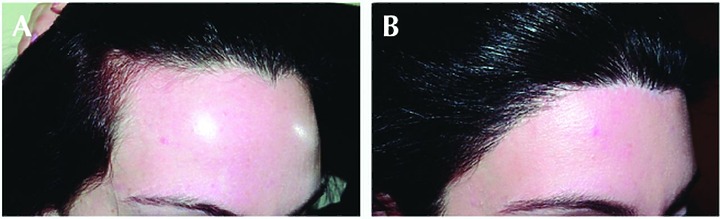 Forehead Reduction Surgery: Procedure, Costs, Alternatives