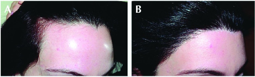 Forehead Reduction Surgery: Procedure, Costs, Alternatives