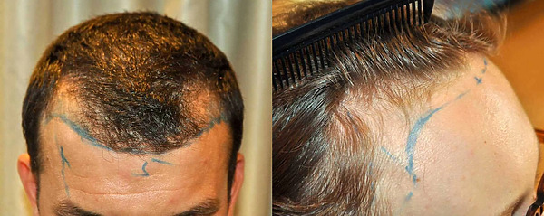 Frontal Balding: Causes, Symptoms, Treatments | Wimpole Clinic