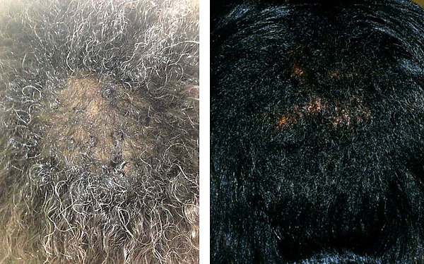 Hair Breakage: Causes, Symptoms, Treatments & Photos