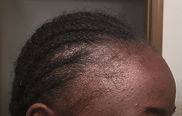 Hair Breakage: Causes, Symptoms, Treatments & Photos