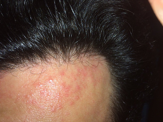 12 Reasons Your Scalp Itches A Day After Washing And How To Treat Them