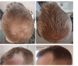 Finasteride Results: Timeline, Photos, Before & After