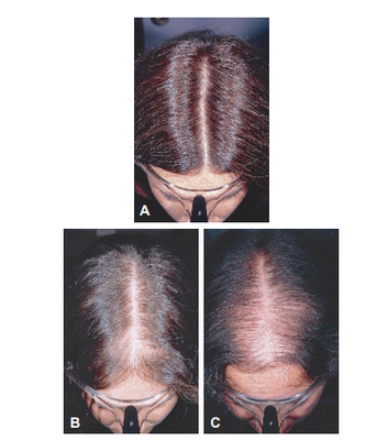 Normal Hair Parting Width vs Thinning: Causes and Treatments