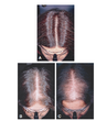 Normal Hair Parting Width vs Thinning: Causes and Treatments