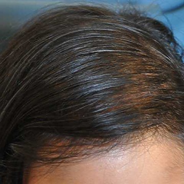 Ludwig Scale: Causes, Stages & Treatment | Wimpole Clinic