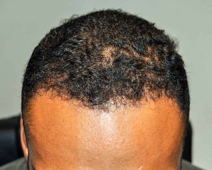 How Many Hair Grafts Do I Need? | Wimpole Clinic