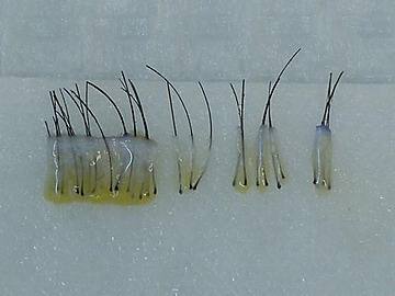 Hair Transplant After 10 Days: Photos, Results & Aftercare