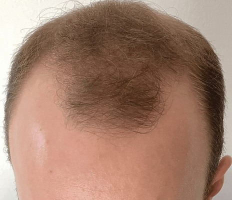 Hair Transplant After 2 Months: Photos, Results, Side Effects