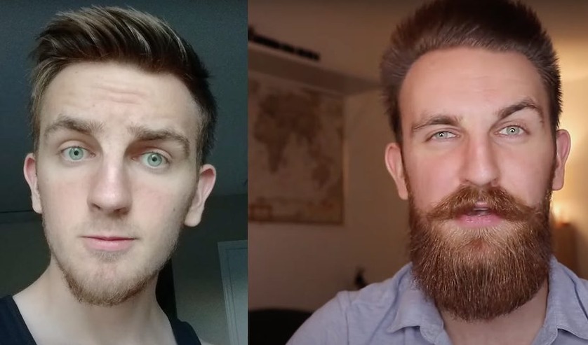 Minoxidil Beard Growth: Before And After | Wimpole Clinic