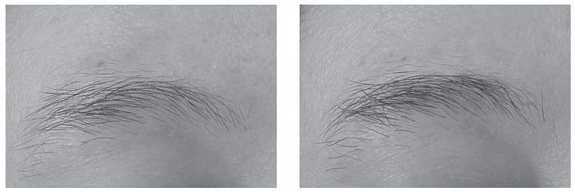 Minoxidil Before And After: Photos & Results | Wimpole Clinic