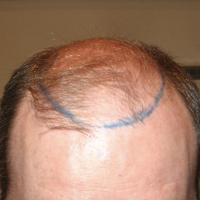 Norwood Stage 5: Photos, Treatments, Results | Wimpole Clinic