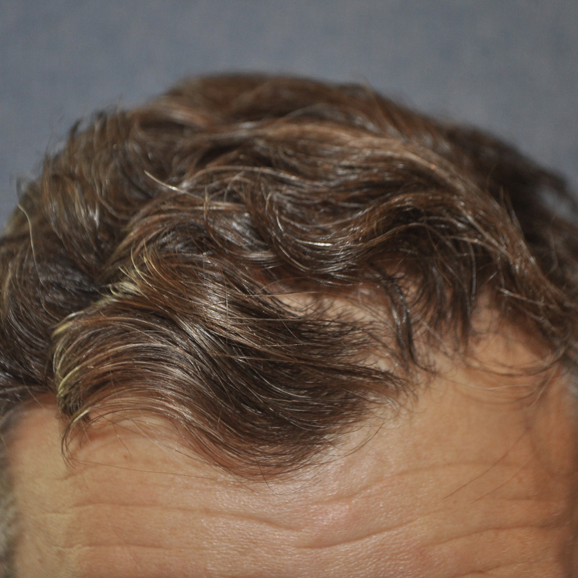 Norwood Scale: Causes, Stages & Treatments | Wimpole Clinic