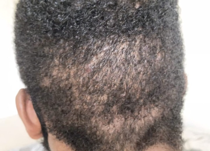 Hair Transplant After 2 Months: Photos, Results, Side Effects