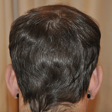 Norwood Stage 3: Photos, Treatments, Results | Wimpole Clinic