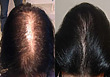 Normal Hair Parting Width vs Thinning: Causes and Treatments