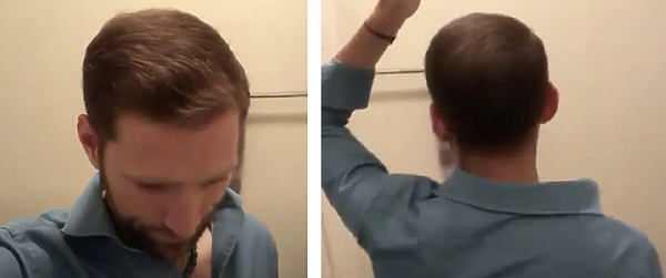 Finasteride Results: Timeline, Photos, Before & After