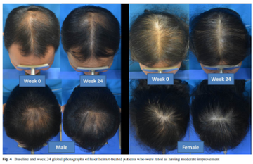 Normal Hair Parting Width vs Thinning: Causes and Treatments