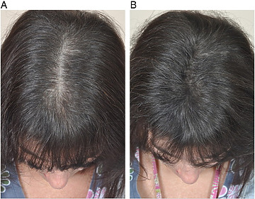 Normal Hair Parting Width vs Thinning: Causes and Treatments
