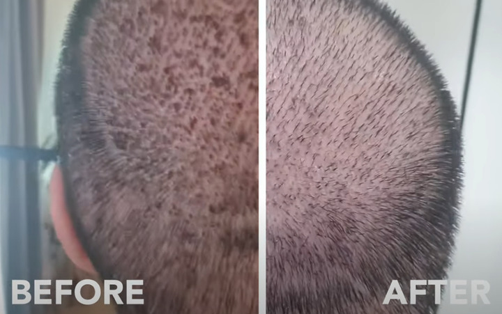 Hair Transplant After 10 Days: Photos, Results & Aftercare