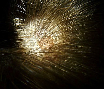 Yeast Infection on Scalp: Causes, Symptoms and Treatment