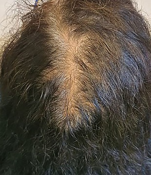 Telogen Effluvium: Symptoms, Causes & Treatment Options