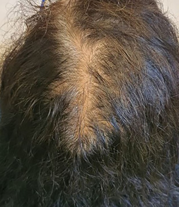 Telogen Effluvium: Symptoms, Causes & Treatment Options