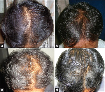 Topical Vs Oral Finasteride: What’s The Difference?