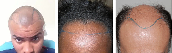 How To Prepare For A Hair Transplant | Wimpole Clinic